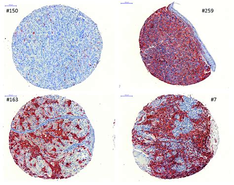 Representative Immunohistochemical Analysis Of Hla Class Ii Antigens On