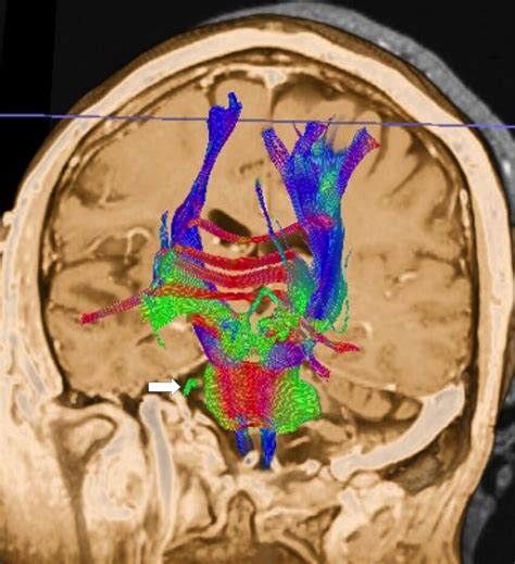 Radiopaedia Case Diffusion Tensor Imaging And Tractography Of The Cisternal And Intradural