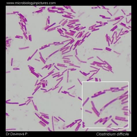 Clostridium Difficile Sporulating Culture Gram Stain And Cell