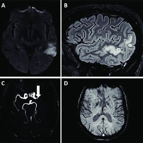 Broca And Left Rolandic Operculum Acute Ischemic Stroke In A Download Scientific Diagram
