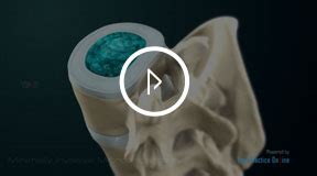 What To Know About Uncovertebral Joint Hypertrophy