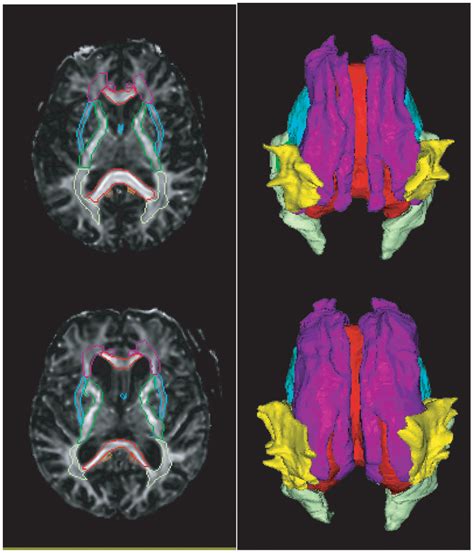 Examples Of The White Matter Tract Segmentation Rows Respectively Download Scientific Diagram