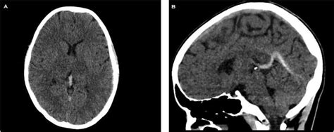 A Axial Noncontrast Ct Image Showing Linear Hyperdensities In The Download Scientific