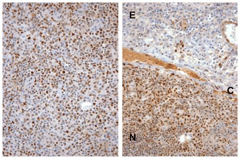 Representative Nicd1 Staining In Angioimmunoblastic T Cell Download Scientific Diagram
