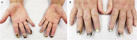 Bilateral Digital Ischemia Nejm