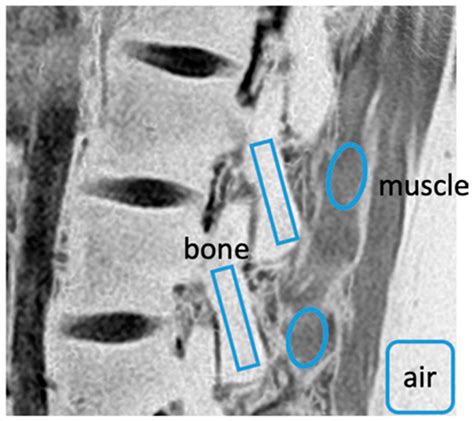 Ultrashort Echo Time And Fast Field Echo Imaging For Spine Bone Imaging