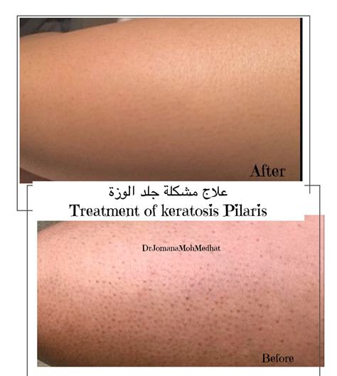 Keratosis Pilaris Treatment Before And After