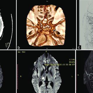 A Non Contrast CT Head Showing Thick Diffuse Subarachnoid Download Scientific Diagram