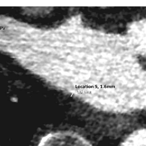 Preselected Locations For Left Atrial Wall Thickness Assessment