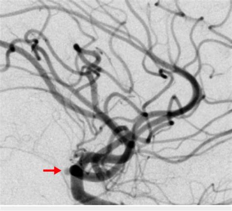 Diagnostic Cerebral Angiogram Lateral View Of The Left Internal