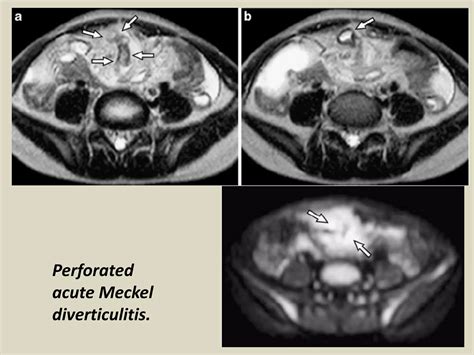 Presentation Radiological Application Of Diffusion Weighted Images In Abdome And Pelvic