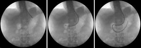 Fluoroscopic Spot Images Showing Advancement Of The Enteroclysis