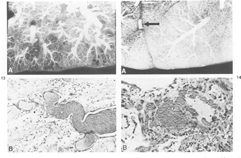 Figure 1 From The Pulmonary Vascular Lesions Of The Adult Respiratory