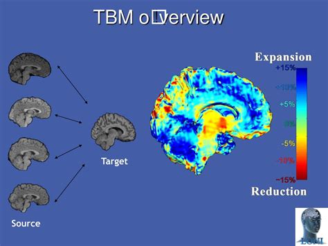 ppt generalized tensor based morphometry tbm for the analysis of