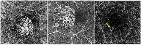 Frontiers Evaluation Of Macular Neovascularization Activity In