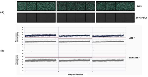 Molecular Bcrabl1 Quantification And Abl1 Mutation Detection As Essential Tools For The