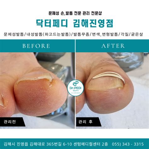 김해내성발톱 창원내성발톱 해결 네이버 블로그
