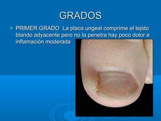 Onicocriptosis Clasificacion T Tratamiento Ppt