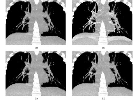 The Mips Of Interpolated Slices Of Real Ct Data Set A Linear B