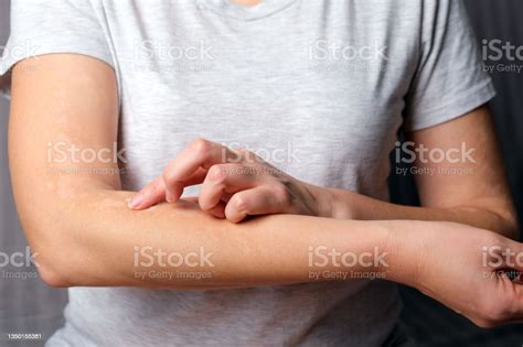 젊은 여성은 가려움 방지 피부염 크림으로 그녀의 손을 얼룩 알레르기 성 피부염 피부 질환 Vitiligo 신경 피부염 질환 습진 또는 알레르기 발진 의료 및 의료 피부에