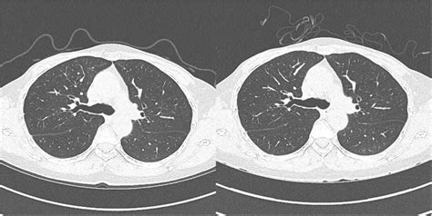 Radiation Dose Reduction Improved Isocenter Accuracy And Ct Scan Time