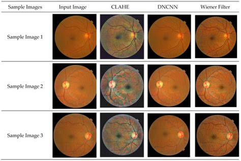Automatic Detection Of Diabetic Hypertensive Retinopathy In Fundus Images Using Transfer Learning
