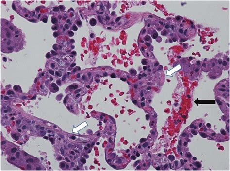 Lung Biopsy Showing Alveolar Hemorrhage Black Arrow And Hyperplasia My XXX Hot Girl