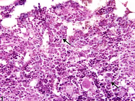 Bone Marrow Infiltration Cellular Mast Cell Nonneoplastic Lesion Atlas