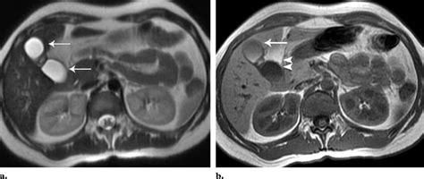 Duplicated Gallbladder In A 24 Year Old Woman With Right Upper Quadrant