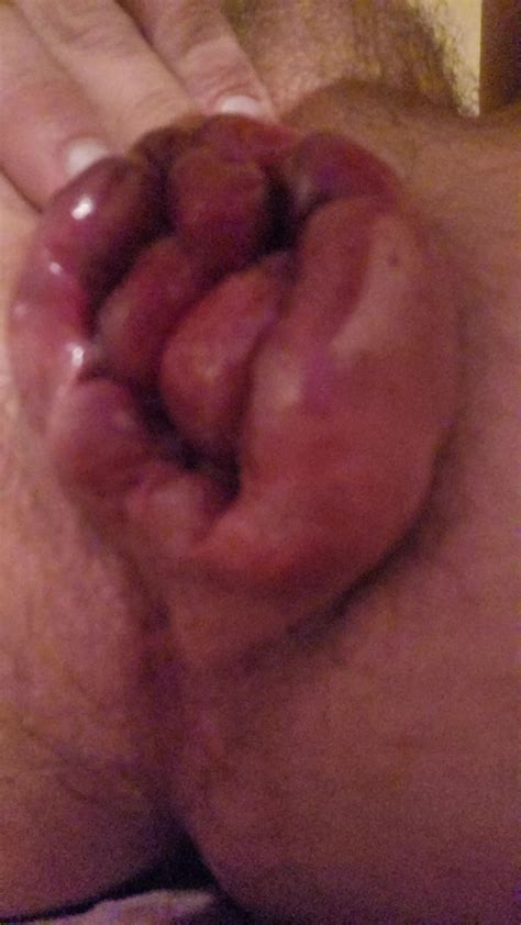 Prolapse Video Thisvid Com