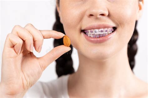 Close Up Of Young Caucasian Smiling Woman With Brackets Show Almond Nut