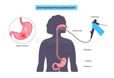 Egd System Stock Illustrations 123 Egd System Stock Illustrations