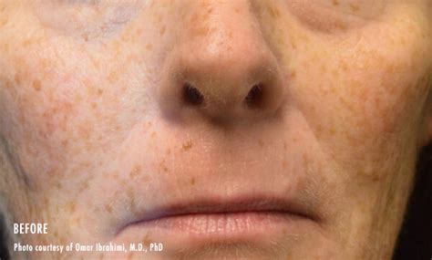 Pico Genesis Facial Rejuvenation Perth MIRA Clinic