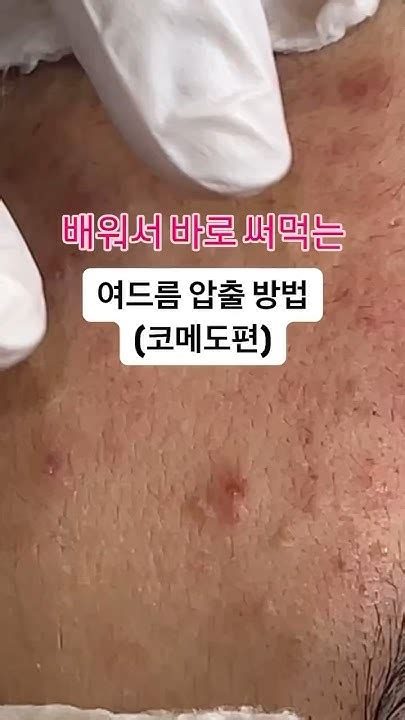 여드름 짜는 방법 너무 쉬워요 Youtube