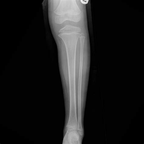 Linear Fracture X Ray