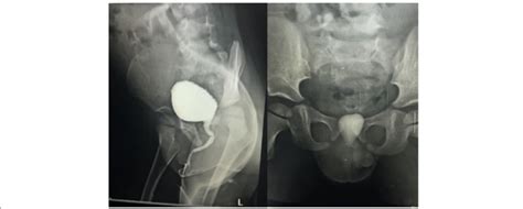 Micturating Cystourethrogram Mcug Showing The Prostatic Utricle Pu Download Scientific