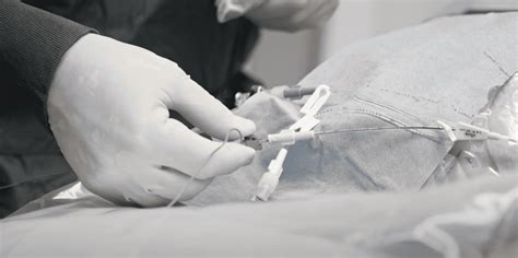 Ecg Guided Central Venous Catheter Cvc Tip Placement A Safer Faster And Cost Effective