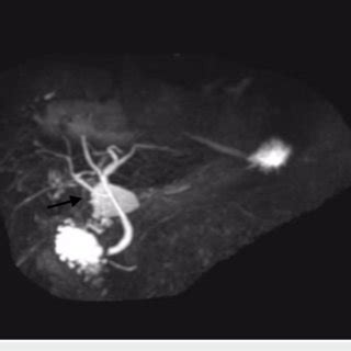 MR Cholangiography MRCP Image Prior To Surgery Showing No Bile Duct Download Scientific
