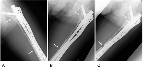 [pdf] Salvage Reconstruction With The Masquelet Technique Following
