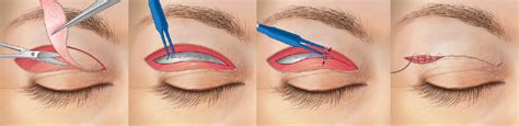 Blepharoplasty Dermatologist Philadelphia Dermatology Practice Main Line Pa Ringpfeil