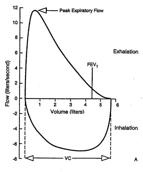 Spirometry Volume Time Curve At Audra Kato Blog