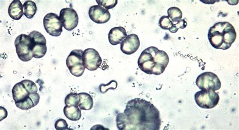 Kristali U Urinu Kod Dece I Odraslih Simptomi Nalaz I Lečenje