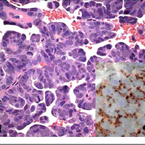 Pdf Ewings Sarcoma Peripheral Primitive Neuroectodermal Tumor Es Pnet Differentiation In