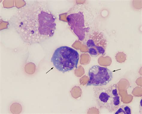 Cryptococcus Archives Eclinpath