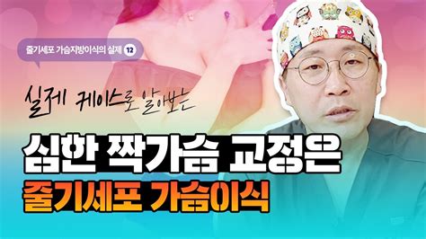 ⭐줄기세포 가슴지방이식 실제12⭐ 심한 짝가슴 줄기세포 가슴지방이식으로 교정 가슴지방이식 줄기세포가슴성형 줄기세포가슴