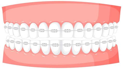 Ceramic Orthodontic Brackets Benefits Costs And Procedure