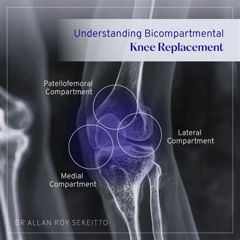 What Is Bicompartmental Knee Replacement Allan Roy Sekeitto Posted