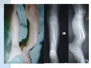 CONGENITAL PSEUDO ARTHROSIS OF TIBIA Jainam Pptx