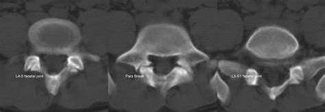Dr Balaji Anvekar Frcr Spondylolysis