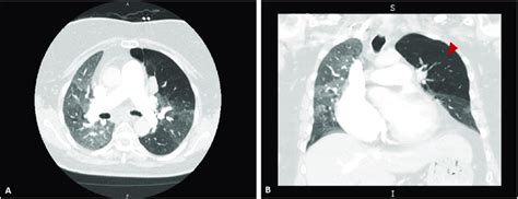 A Transverse View Of The Ct Chest Showing Hyperlucent Left Upper Lobe